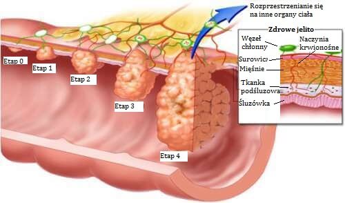 Social Trends : polipy-jelita-grubego-rodzaje-przyczyny-objawy-leczenie
